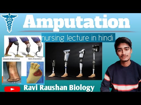 Amputation,cause,types,levels, complications, management | nursing ...