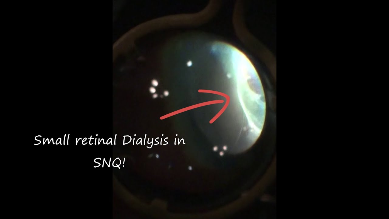 Traumatic Retinal detachment due to Retinal Dialysis. - YouTube