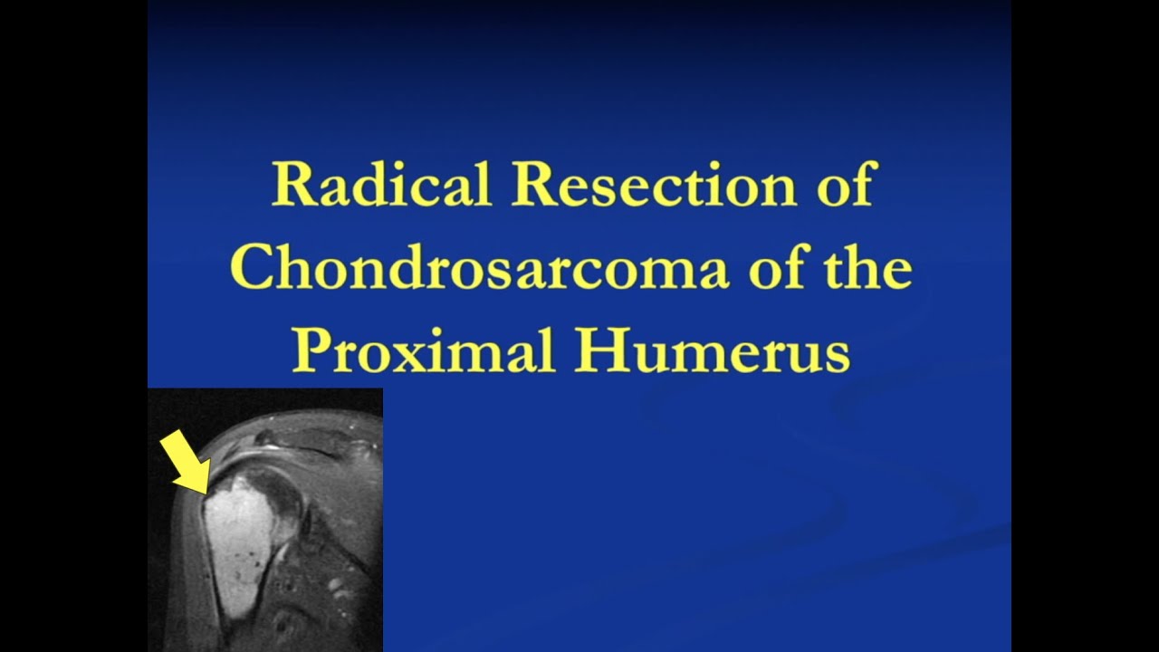 Limb Sparing Resection of the Proximal Humerus due to a Chondrosarcoma ...