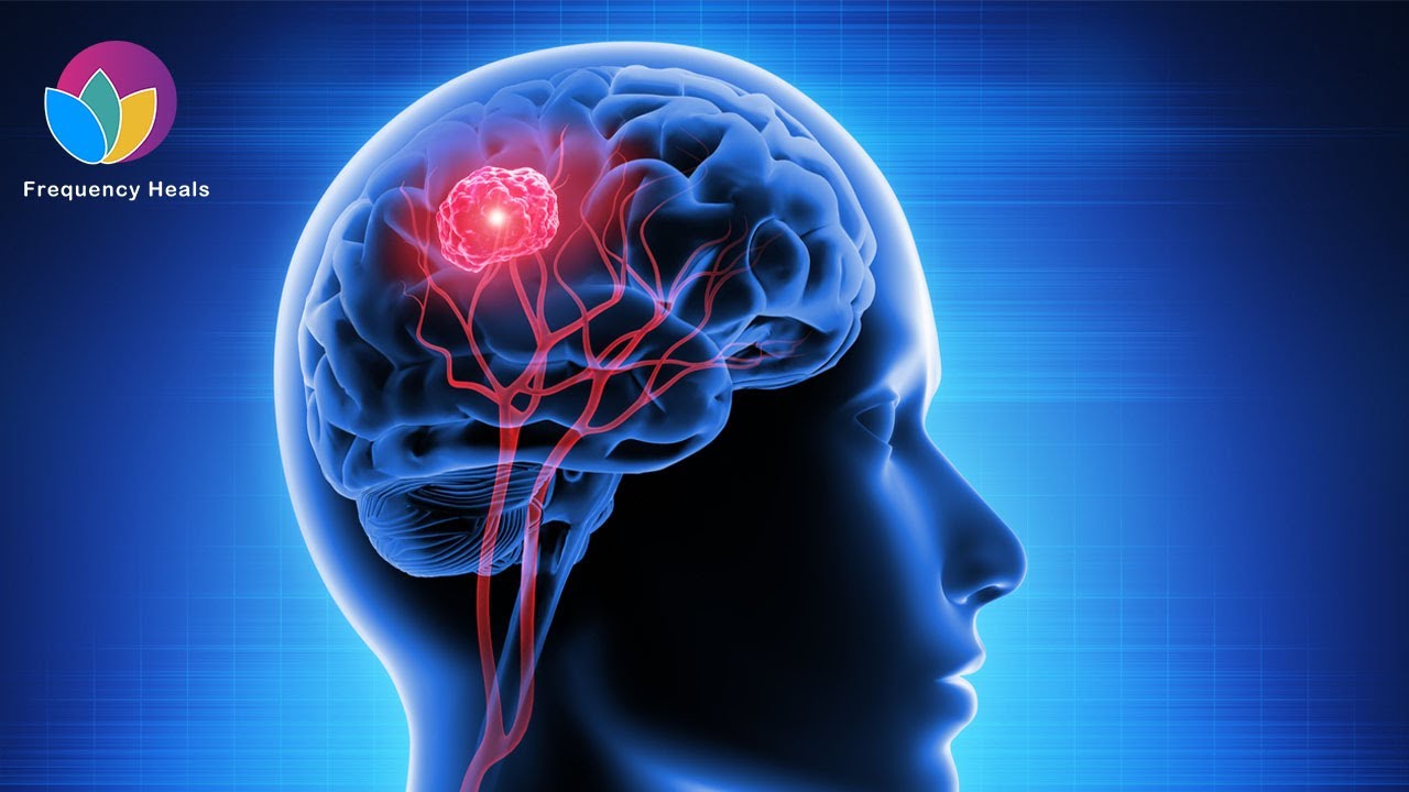 Glioma Therapy | Remove Tumor Cells & Shrink Tumor Size & Stop ...