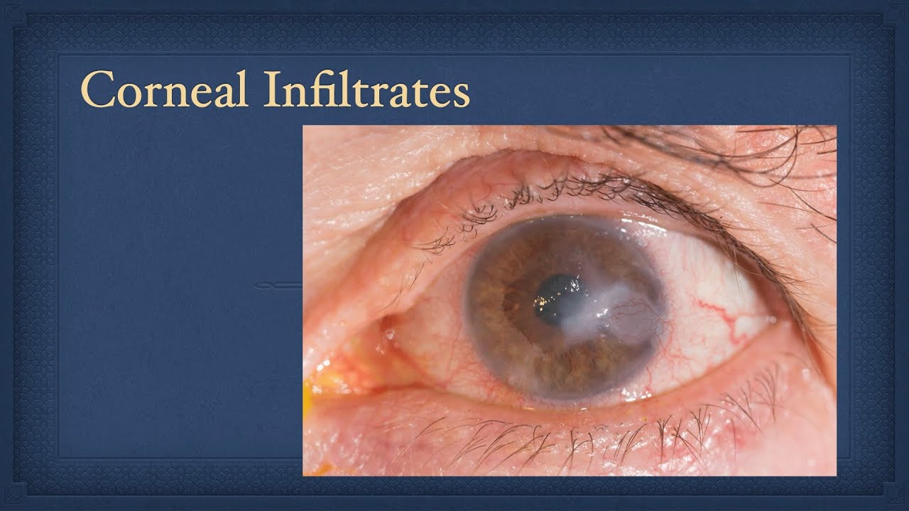 Corneal Inflammation I Sign I Deep Lesion I Corneal Infiltrates I - YouTube