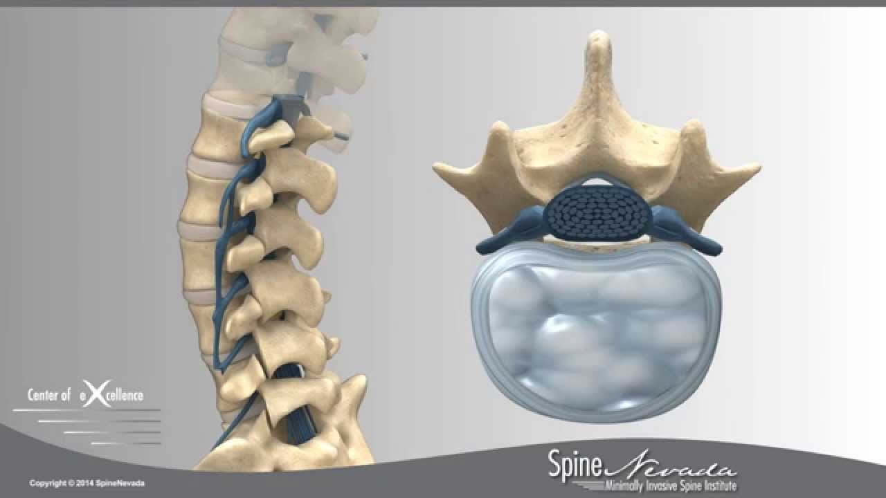 Minimally Invasive Spine Surgery Carson, Reno, Sparks, Nevada ...