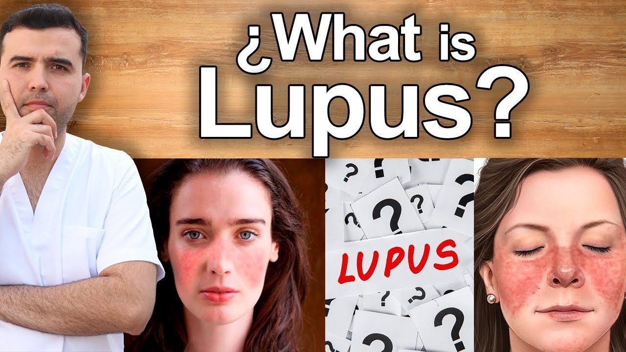 What is Lupus? - Learn More About This Serious Auto-Immune Disease ...