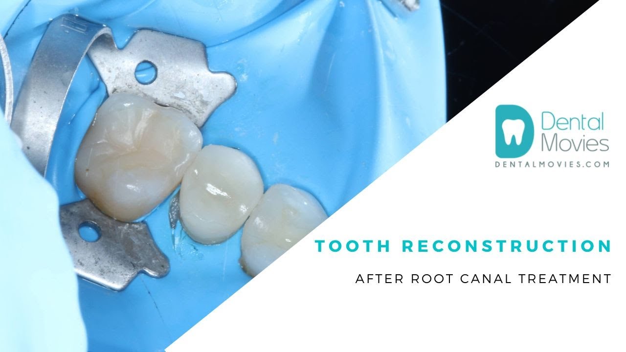 Tooth reconstruction after root canal treatment 🦷 - YouTube