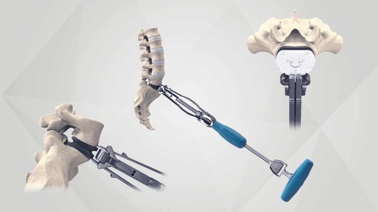 Lumbar Disc Replacement: LP ESP Surgical Technique from YouTube - YouTube