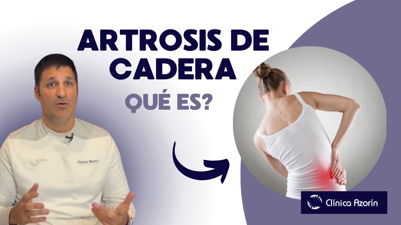 Artrosis de cadera: Qué es, síntomas y cómo tratarlo - YouTube
