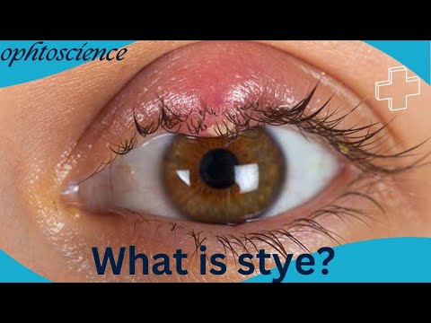 Stye |How to get rid of stye fast |stye or Chalazion - YouTube