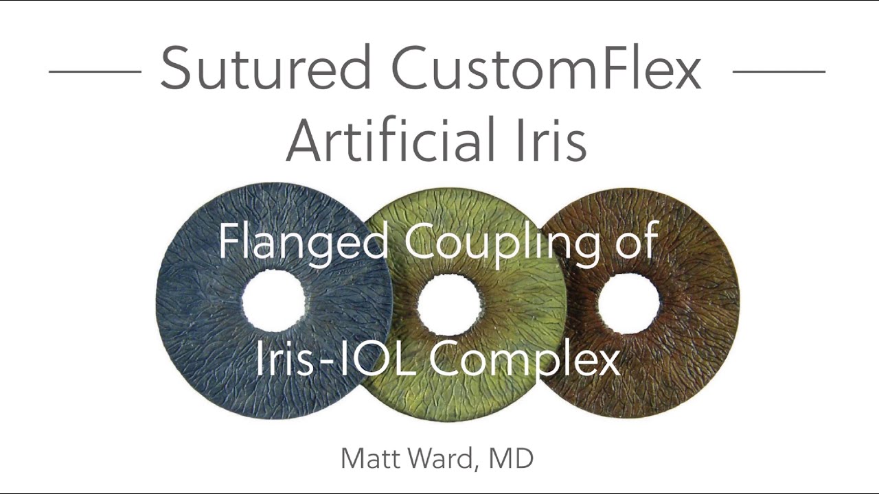 Sutured CustomFlex Artificial Iris - Flanged Coupling of Iris-IOL ...