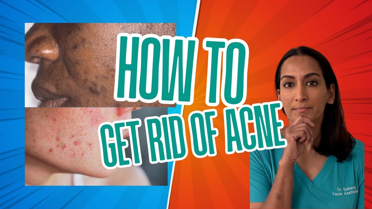 How to Get Rid of Acne Forever | Myths Debunked - YouTube