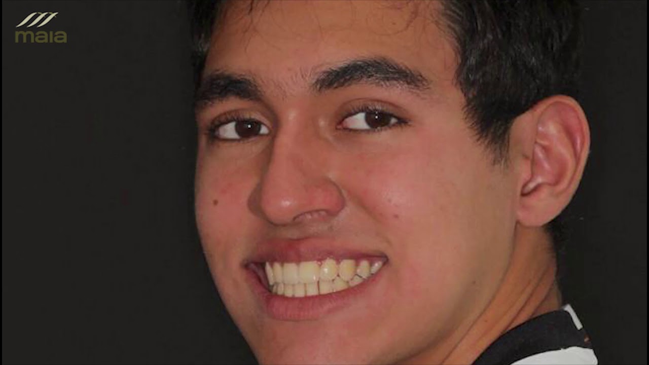 Sistemas Ertty - Aparelho ortodôntico para classe III (gap III) - YouTube