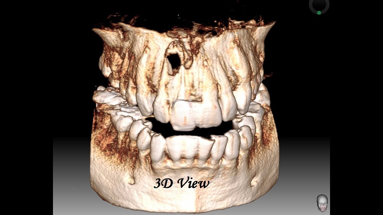 Management of Large Radicular Cyst by Conservative Surgical. Radicular ...