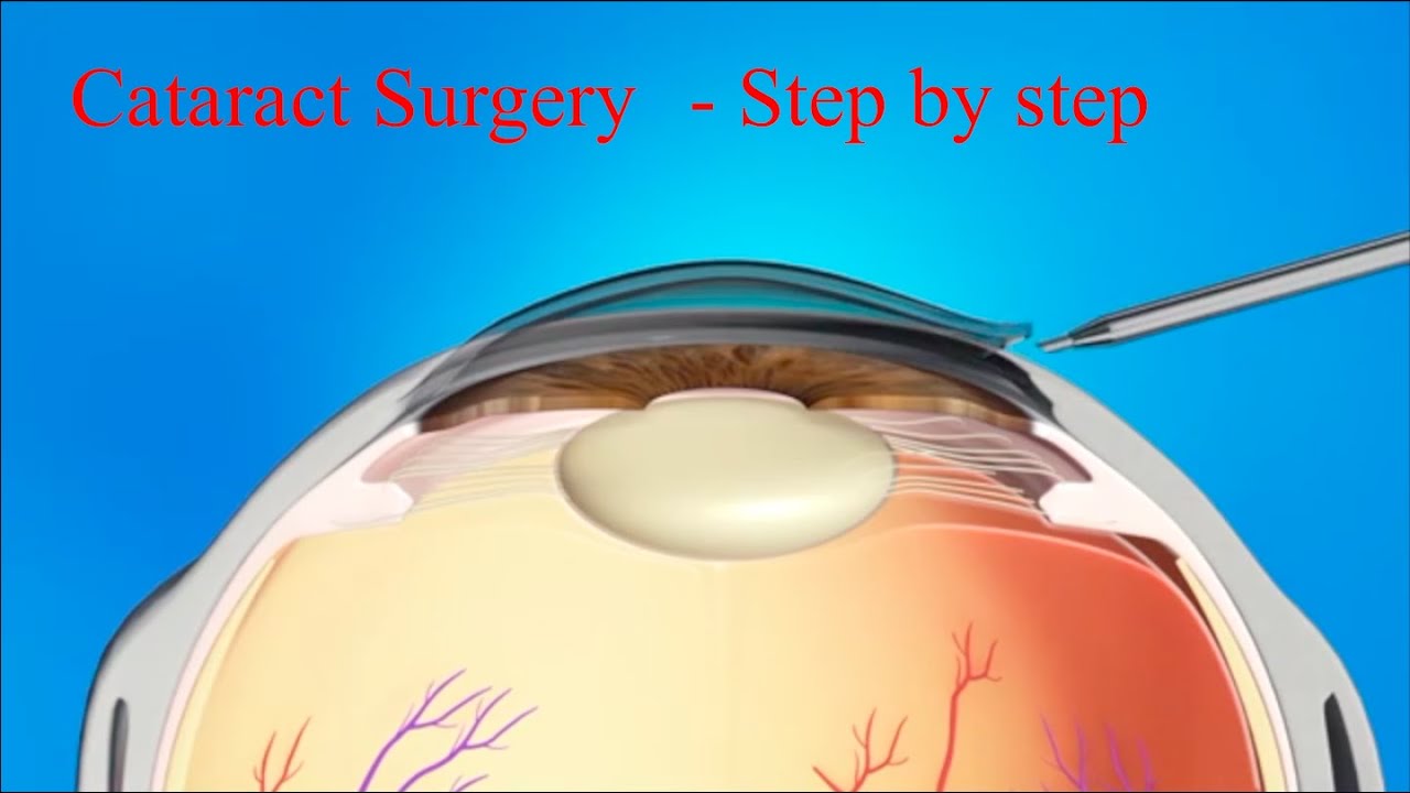 Cataract Surgery - Step by step - YouTube