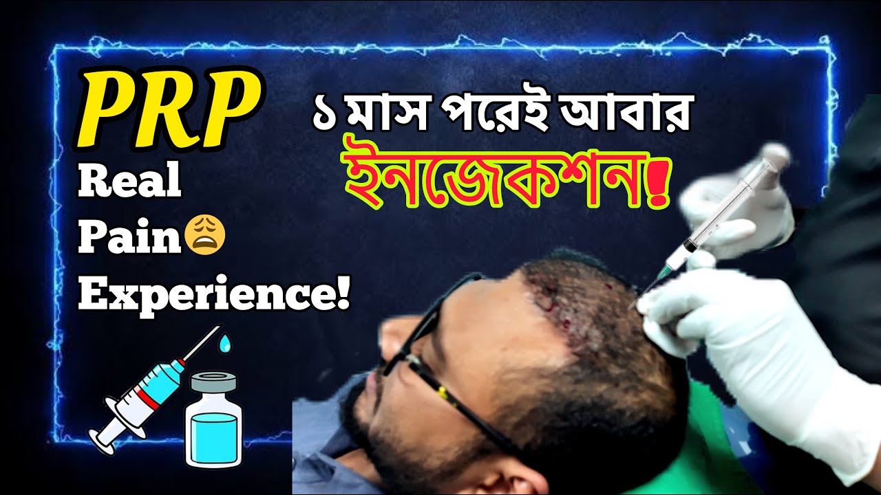 Hair Transplant এর ১ মাস পর PRP! এতটা ব্যথা আমি ভাবিনি! 😰 | PRP ...