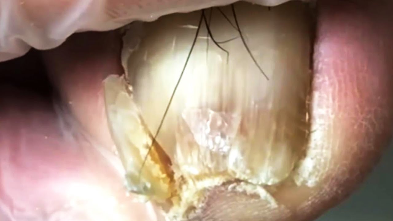 Toenails hide huge ingrown nails, dig it out【Crazy pedicure room】 - YouTube