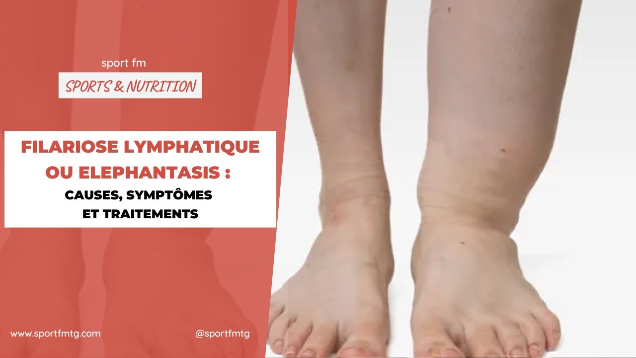 SPORTS & NUTRITION - FILARIOSE LYMPHATIQUE OU ELEPHANTASIS : CAUSES ...