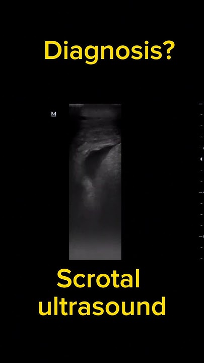 Acute Idiopathic Scrotal Edema Ultrasound Radiologysonology Youtubeshorts Shortvideo Shorts