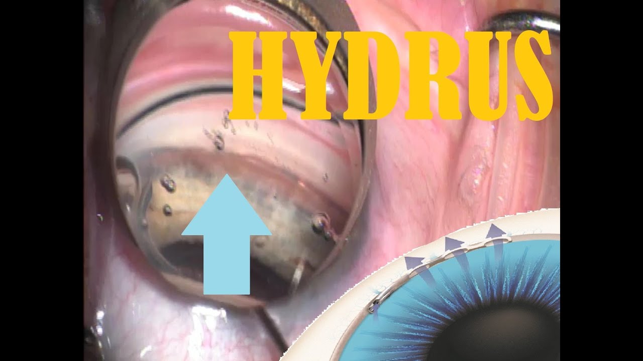 How to: HYDRUS MIGS shunt from Ivantis - YouTube