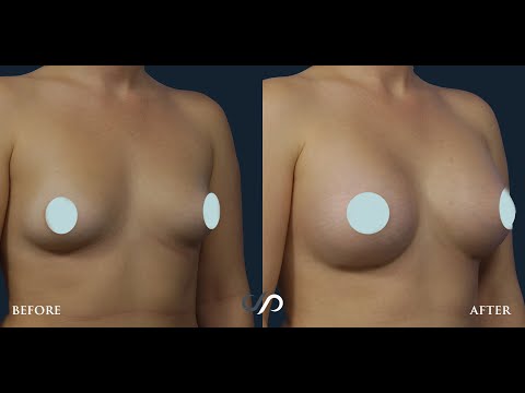 #3 Rapid Recovery Breast Augmentation with Results  | Dr. David Stoker