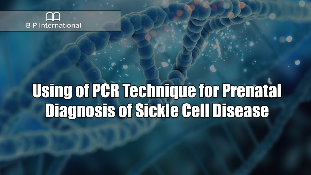 Using of PCR Technique for Prenatal Diagnosis of Sickle Cell Disease ...
