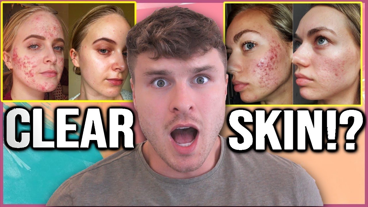 THIS Small Change Has A HUGE Impact On Acne! (THE ACNE SHOW EP 2) - YouTube