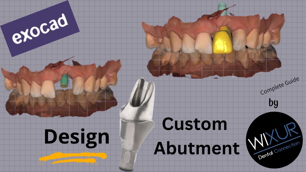 Design A Custom Abutment (Maxillary Anterior) - YouTube