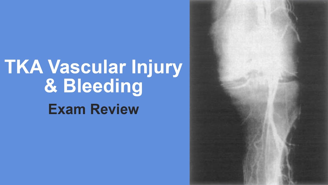 TKA Vascular Injury & Bleeding Exam Review - Thomas Sculco, MD - YouTube
