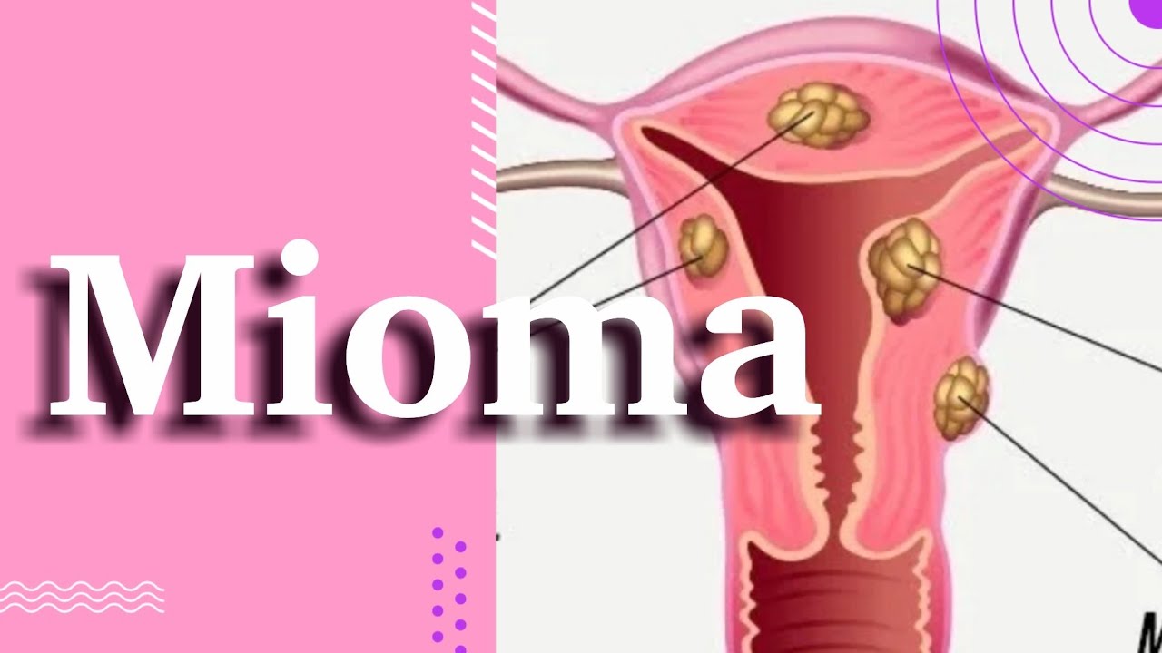 MIOMA:SUBSEROSO, INTRAMURAL E SUBMUCOSO| tumores benÍgnos ou malignos ...