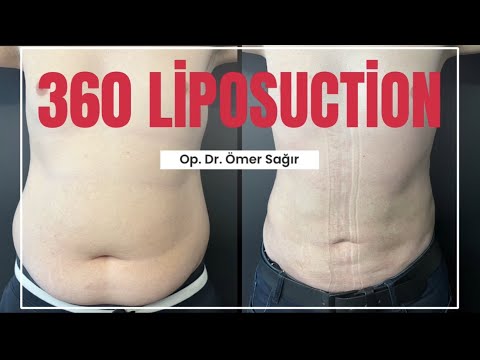 360 Vaser Liposuction Sonucu - YouTube