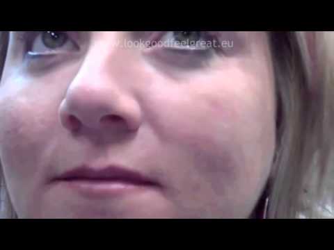 Instantly Ageless video 23 www dermakademi com mp4