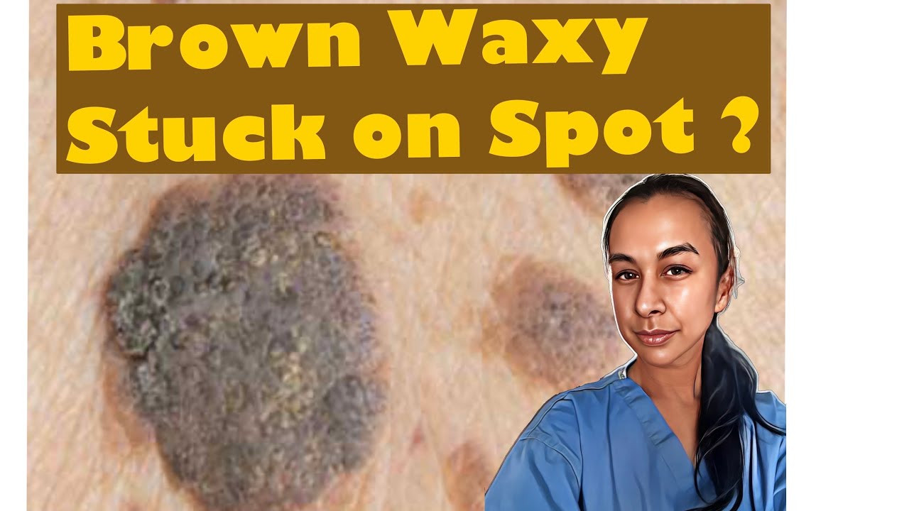 Brown Waxy Spots on Skin? Seborrheic Keratosis Explained by a Plastic ...
