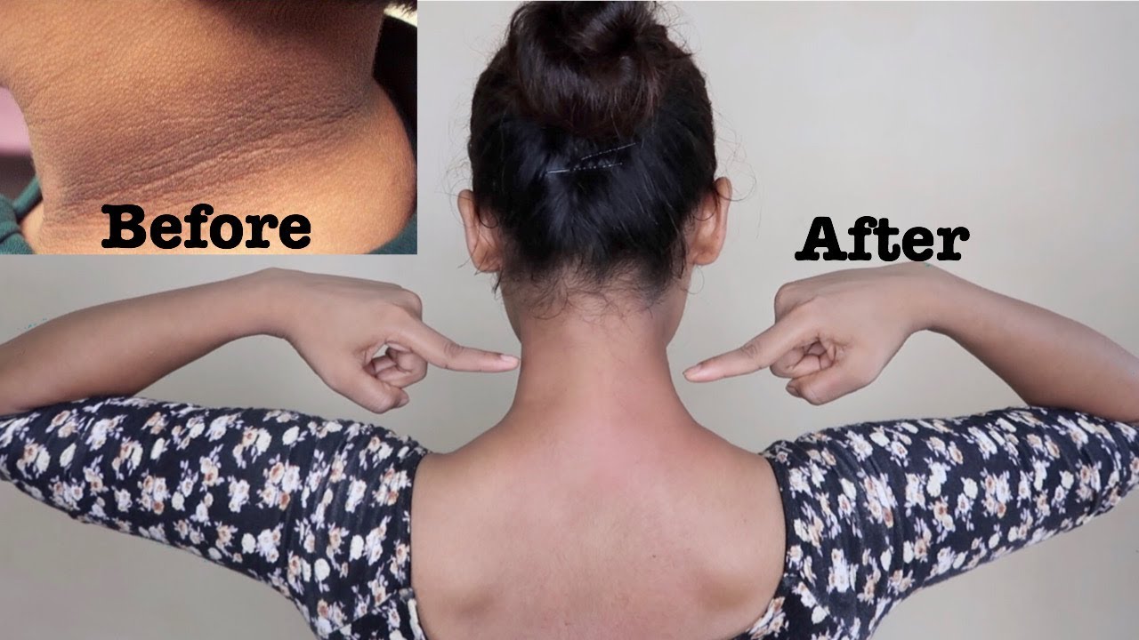 Live Result In Just 15 Minutes Dark Neck Whitening 100 Works YouTube live-result-in-just-15-minutes-dark-neck-whitening-100-works-youtube