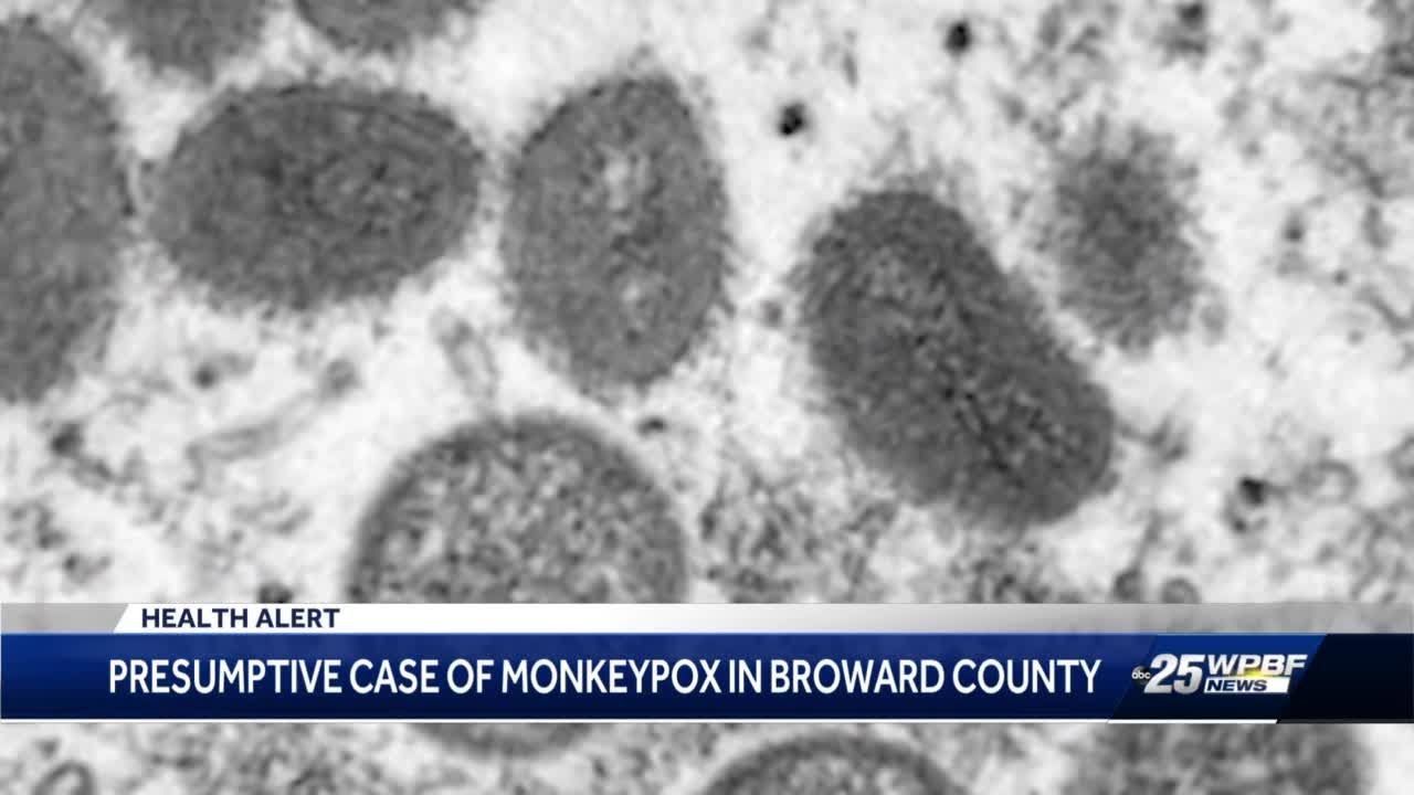 Expert weighs in on presumptive monkeypox case in South Florida - YouTube
