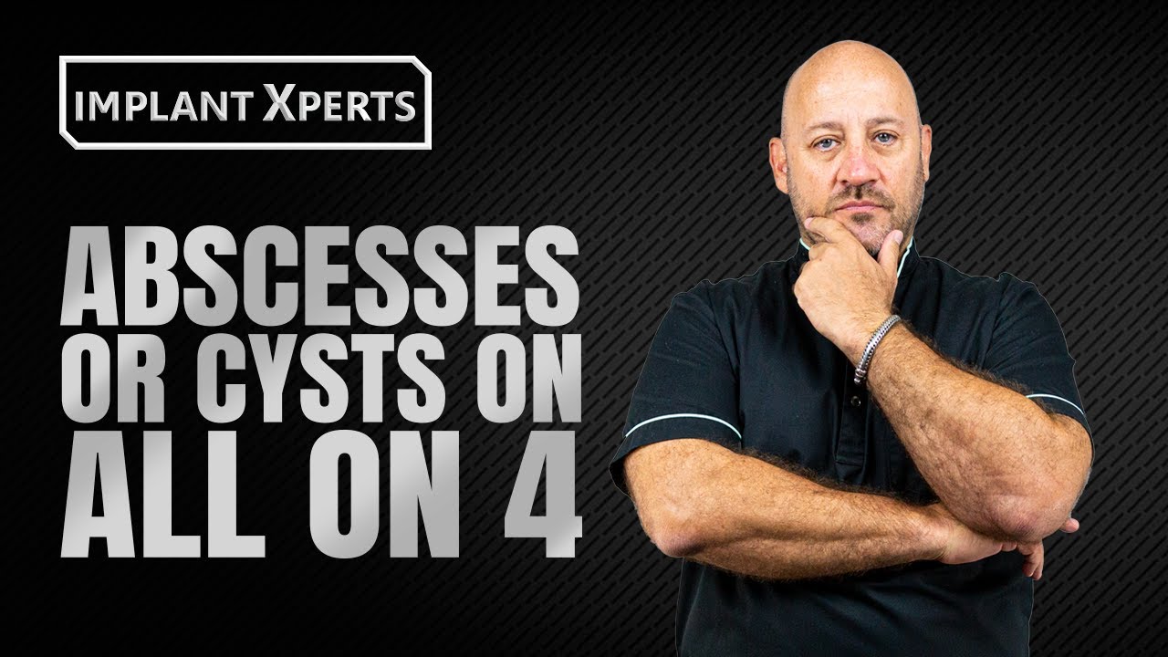 Understanding Abscesses or Cysts on All-On-4 Dental Implants: Causes ...