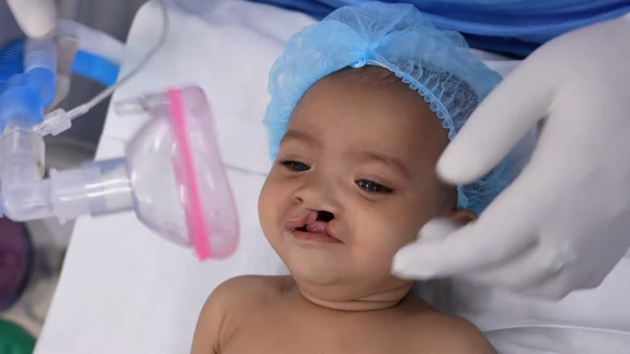 3 Months old Cleft Lip Baby Going under ANESTHESIA - YouTube
