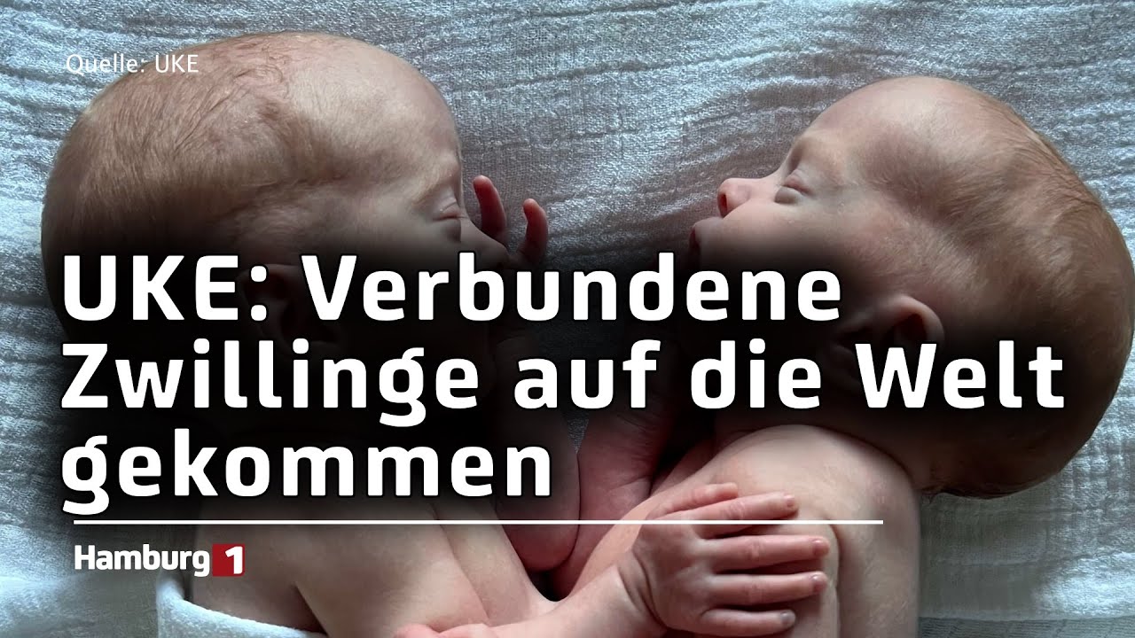 Verbundene Zwillinge sind im UKE auf die Welt gekommen - YouTube