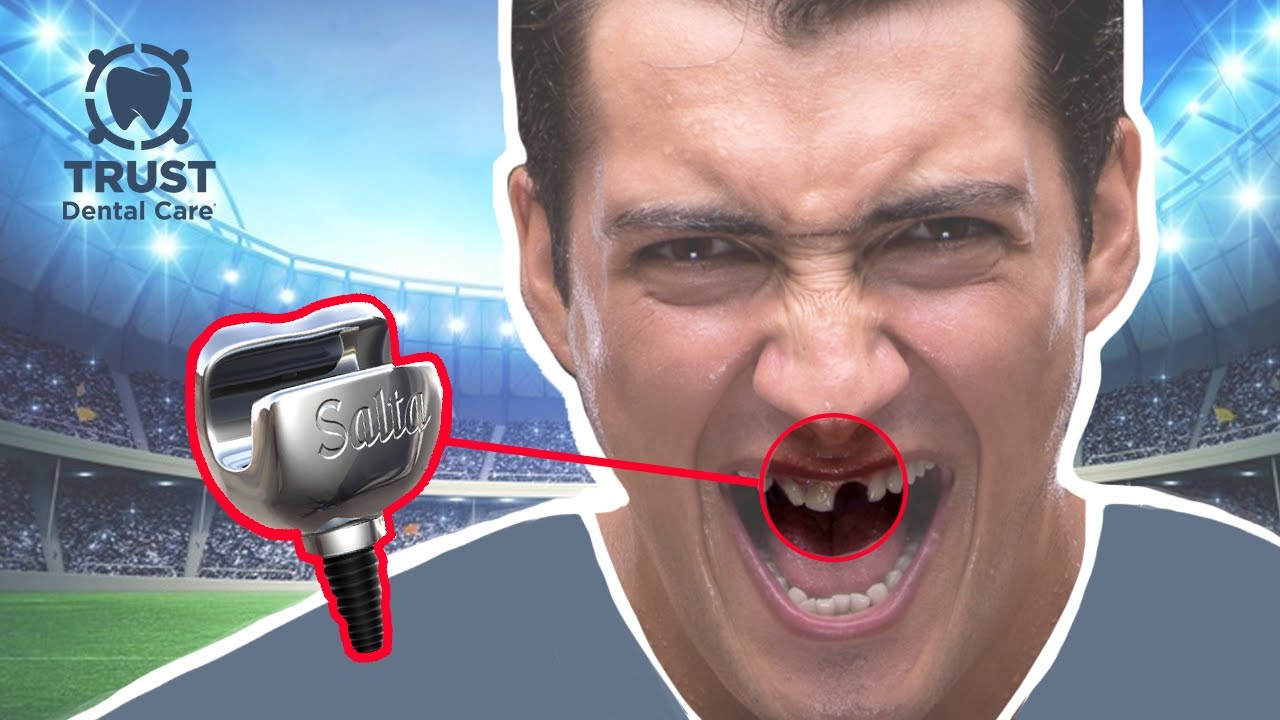 Dental implants: You won't believe how rugby players replace their ...