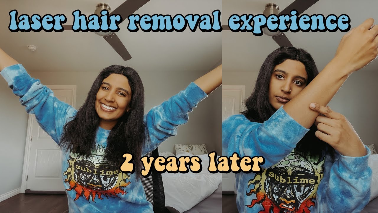 my laser hair removal experience! | 2 years later - YouTube