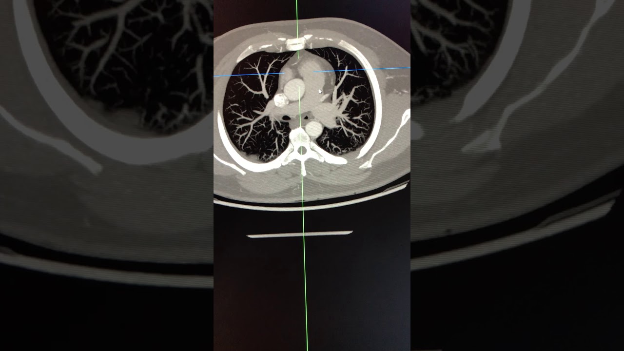 CT assessment - coronary arterial branches: conus artery - YouTube