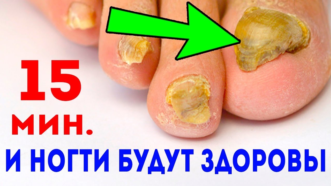 15 мин грибок ногтей как ветром сдует Лечение грибка ногтей Youtube