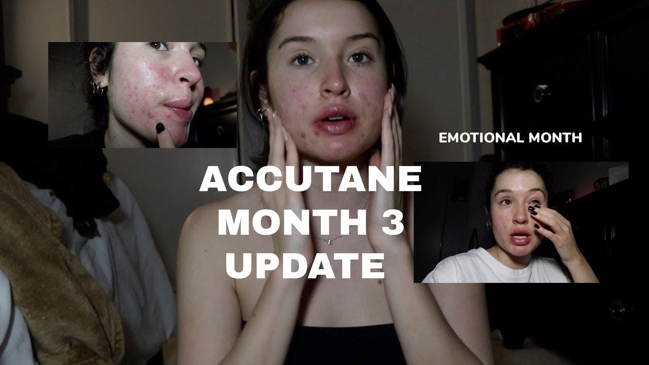 MY ACCUTANE JOURNEY: Month 3 - YouTube