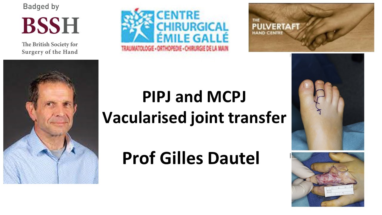 PIPJ and MCPJ vacularised joint transfer - YouTube