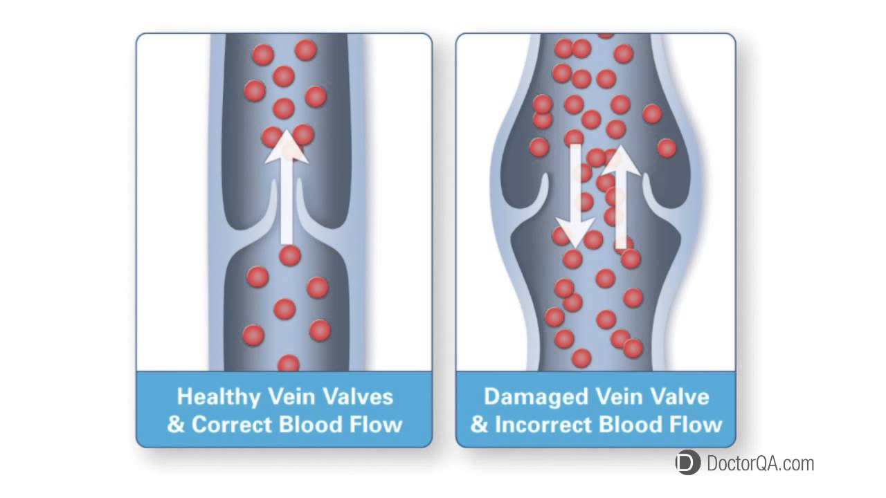 How many treatments does vein removal take? - Michael F. Bardwil, MD ...