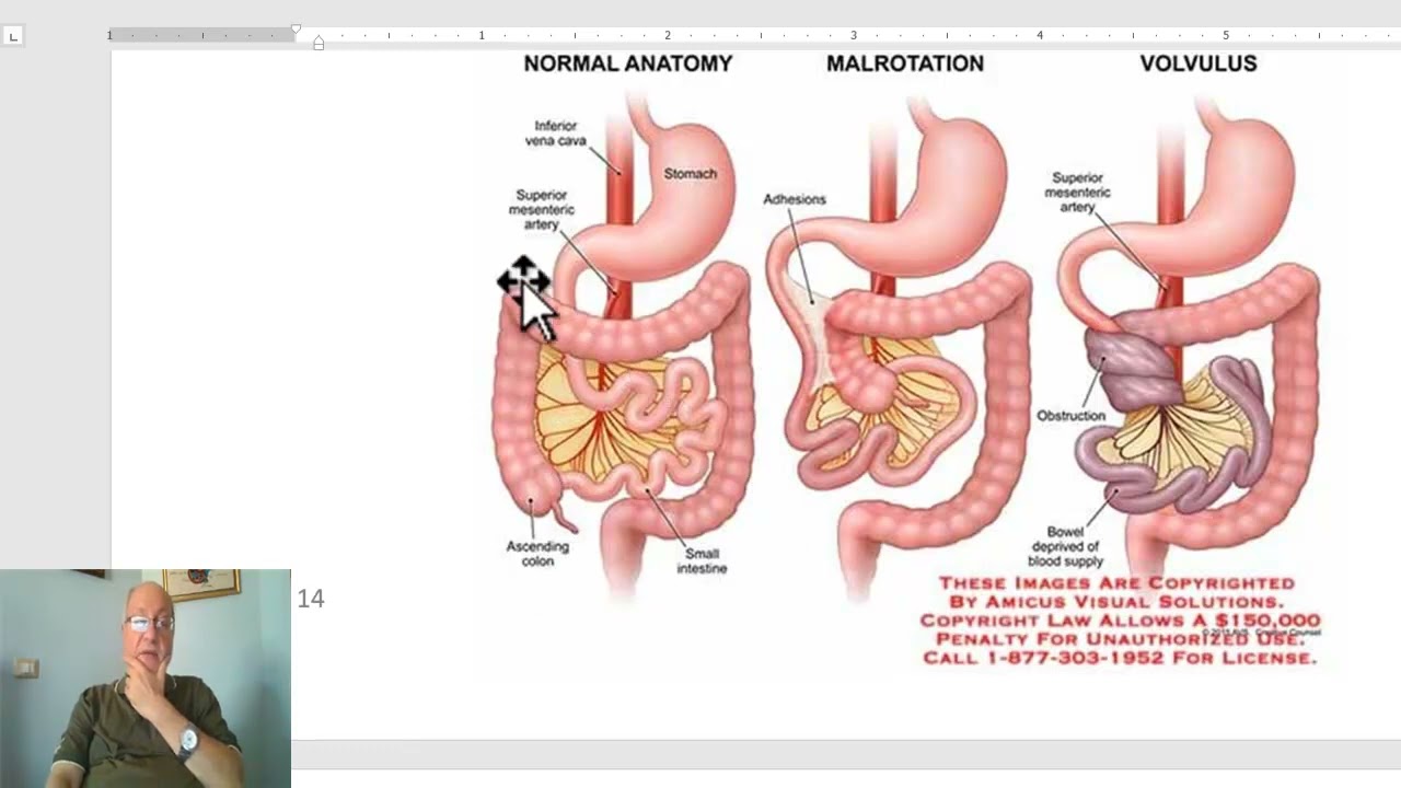 Paediatric surgery in Arabic 7 ( Disorders of Intestinal Rotation) , by ...