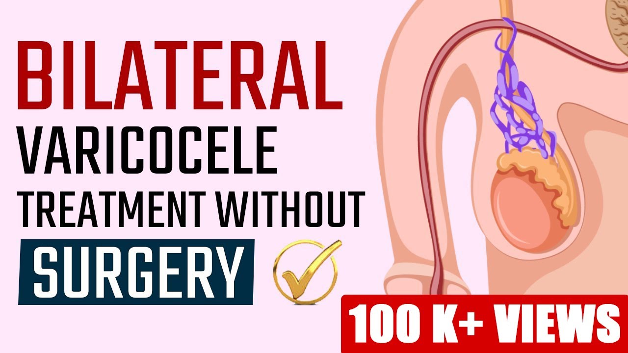 Bilateral Varicocele Treatment Without Surgery Dr Health Youtube