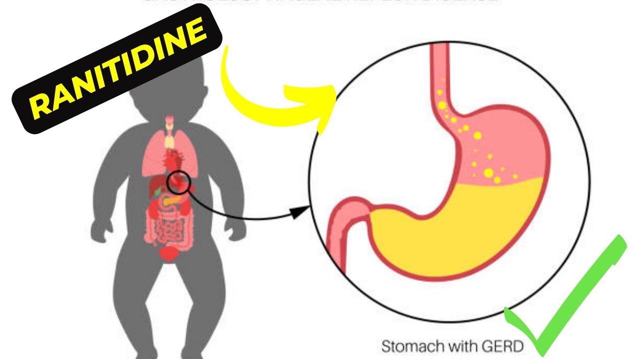 The Risks and Benefits of Taking Ranitidine for Acid Reflux - YouTube
