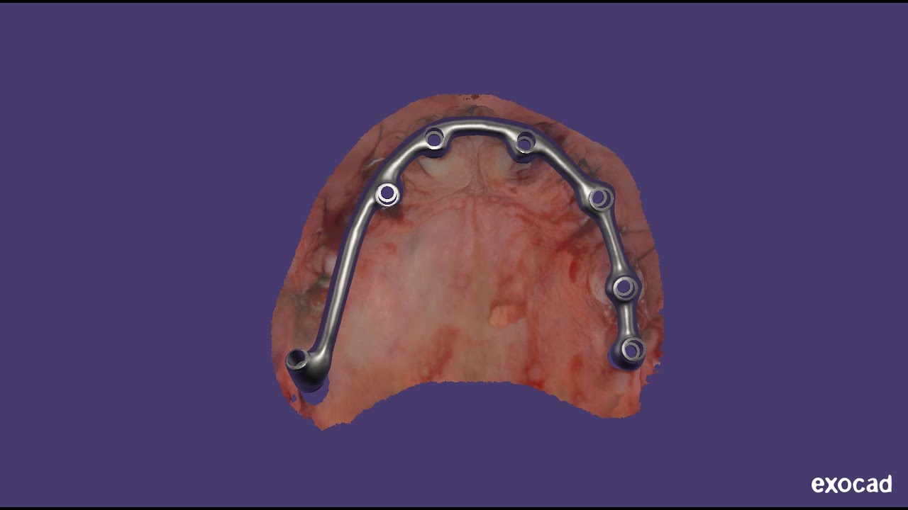 Upper all on 7 titanium bar designing for MU screw retained implant in ...