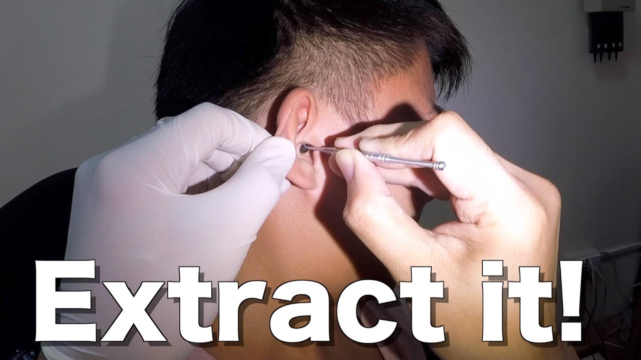 Removing Man's Earwax Using Ear Curette | Extract it! - YouTube