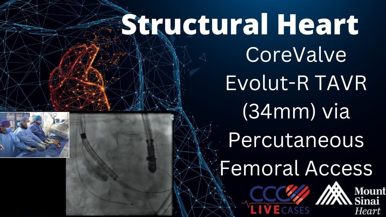 CoreValve Evolut-R TAVR (34mm) via Percutaneous Femoral Access ...