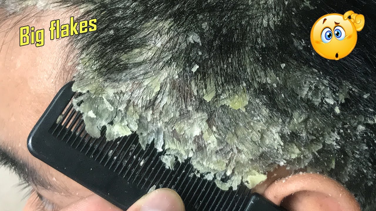 Big flakes ! Dandruff Scratching || Itchy Dry Scalp Treatment #537 ...
