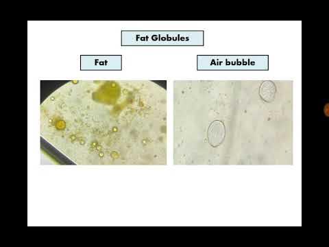 Stool Analysis 11 Undigested food - YouTube